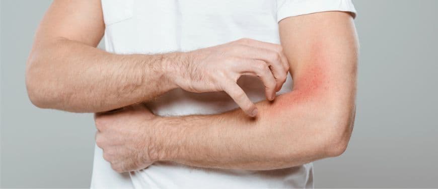 Guía completa sobre dermatosis seborreica: síntomas, causas y ...