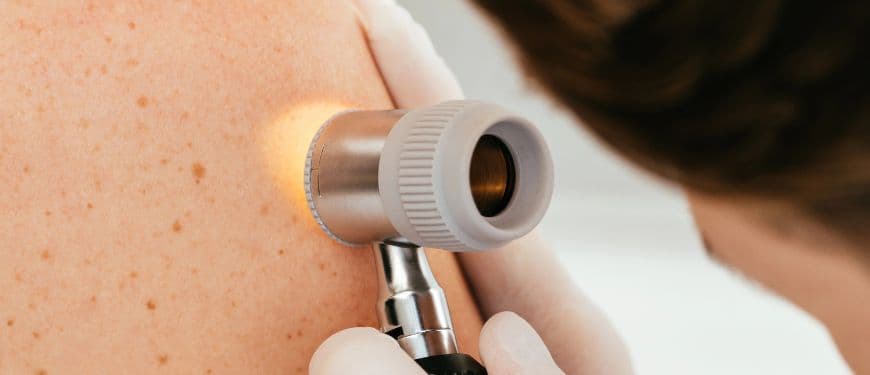 Qué es el melanoma maligno y cómo prevenirlo | Blog PromoFarma